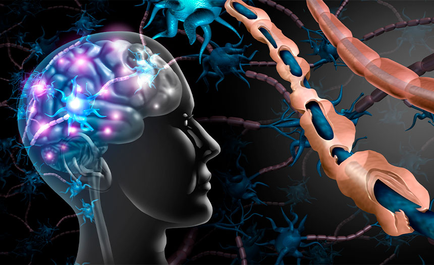 La esclerosis múltiple y sus síntomas - Universal México - Universal México