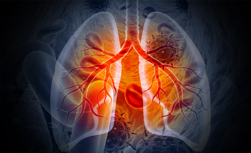 Cáncer de pulmón: mitos y realidades - Universal México - Universal México